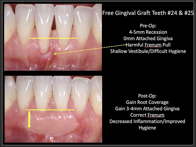 Gum Grafting Huntington Beach Cosmetic Periodontics Dr Braga Gum Grafting Huntington Beach Cosmetic Periodontics Dr Braga